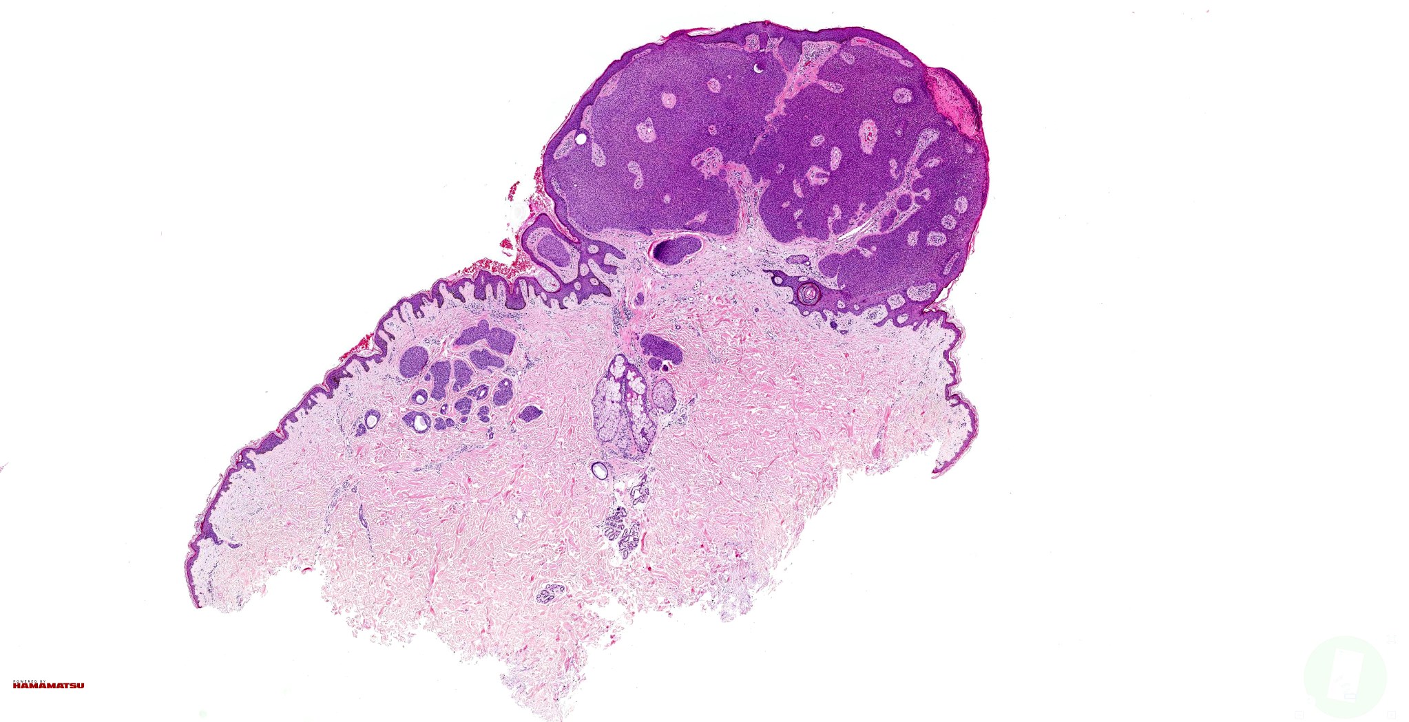 Poroma including hidroacanthoma simplex & dermal duct tumor – McKee Derm