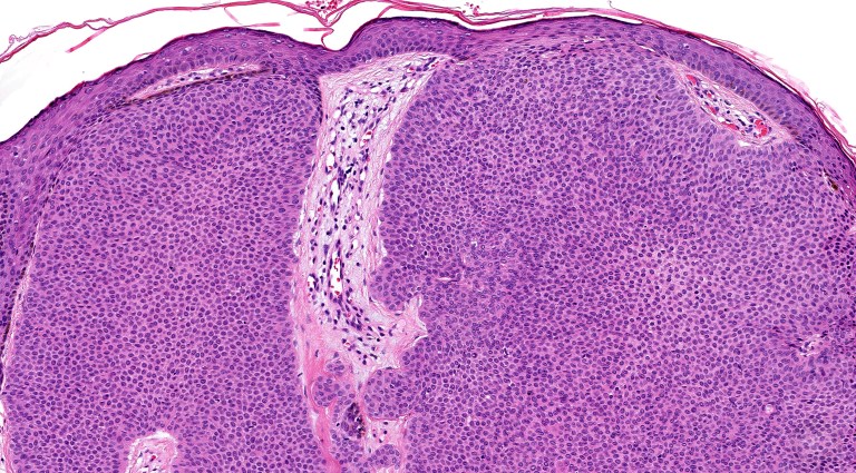 Poroma including hidroacanthoma simplex & dermal duct tumor – McKee Derm
