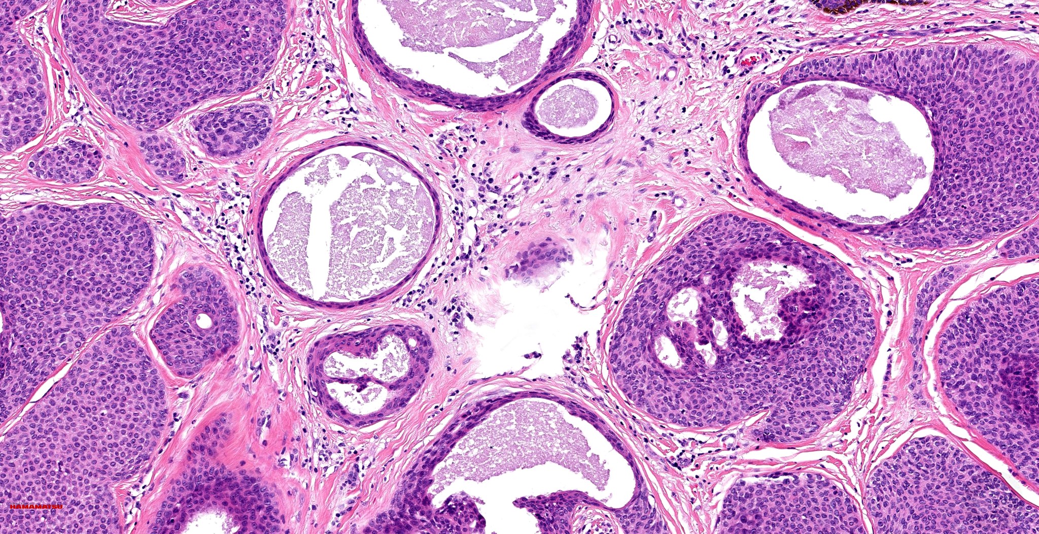 Poroma including hidroacanthoma simplex & dermal duct tumor – McKee Derm
