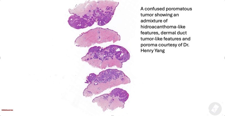 Poroma including hidroacanthoma simplex & dermal duct tumor – McKee Derm
