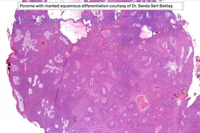 Poroma including hidroacanthoma simplex & dermal duct tumor – McKee Derm