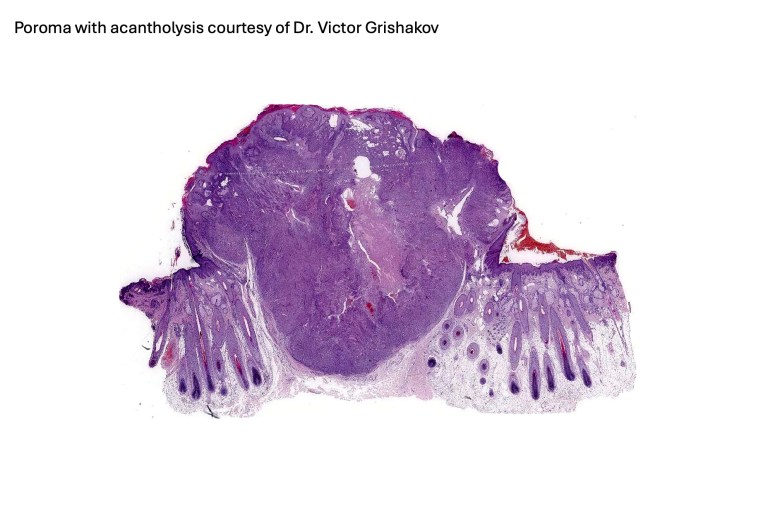 Poroma including hidroacanthoma simplex & dermal duct tumor – McKee Derm