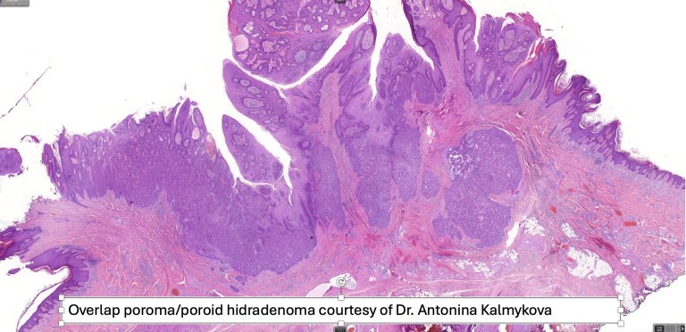 Poroma including hidroacanthoma simplex & dermal duct tumor – McKee Derm