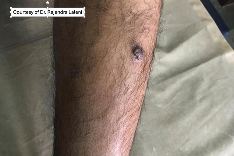 Poroma including hidroacanthoma simplex & dermal duct tumor – McKee Derm