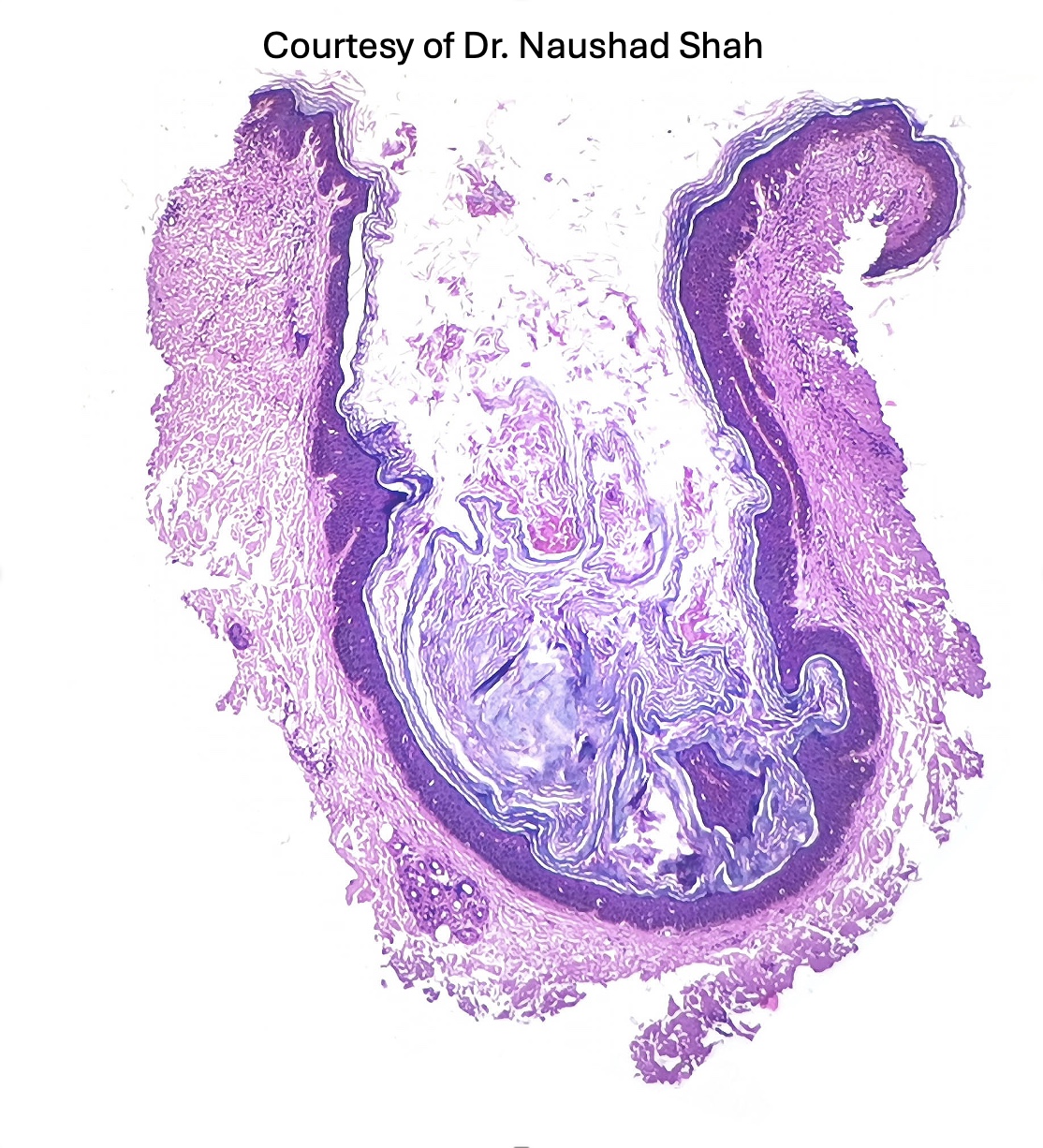Dilated pore of Winer – McKee Derm