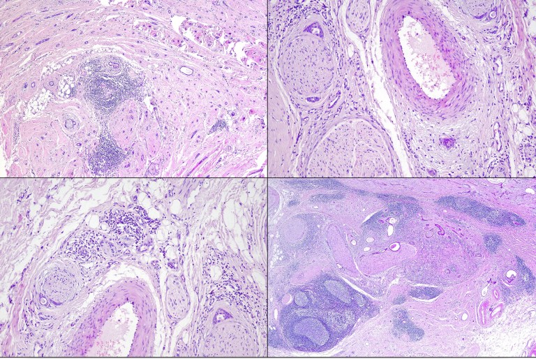 Nevus sebaceus (sebaceous nevus of Jadassohn, organoid nevus) – McKee Derm