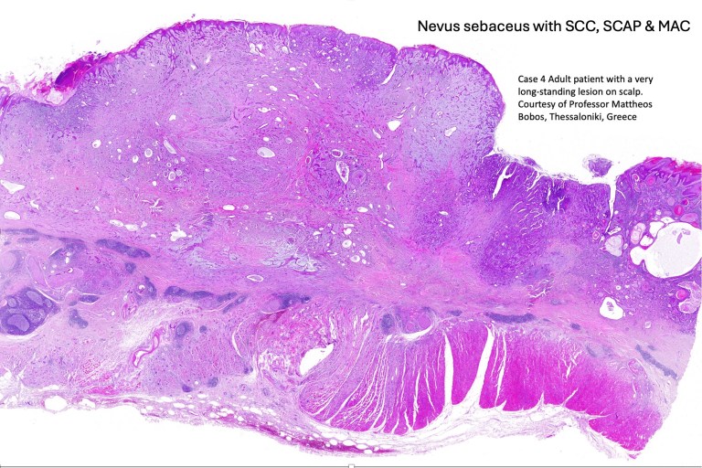 Nevus sebaceus (sebaceous nevus of Jadassohn, organoid nevus) – McKee Derm