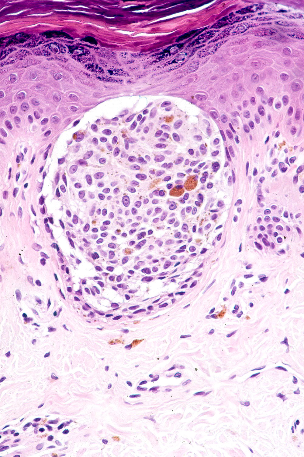Common nevi- basics for beginners – McKee Derm