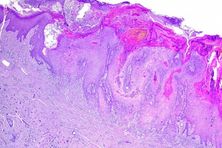 Nevus sebaceus (sebaceous nevus of Jadassohn, organoid nevus) – McKee Derm