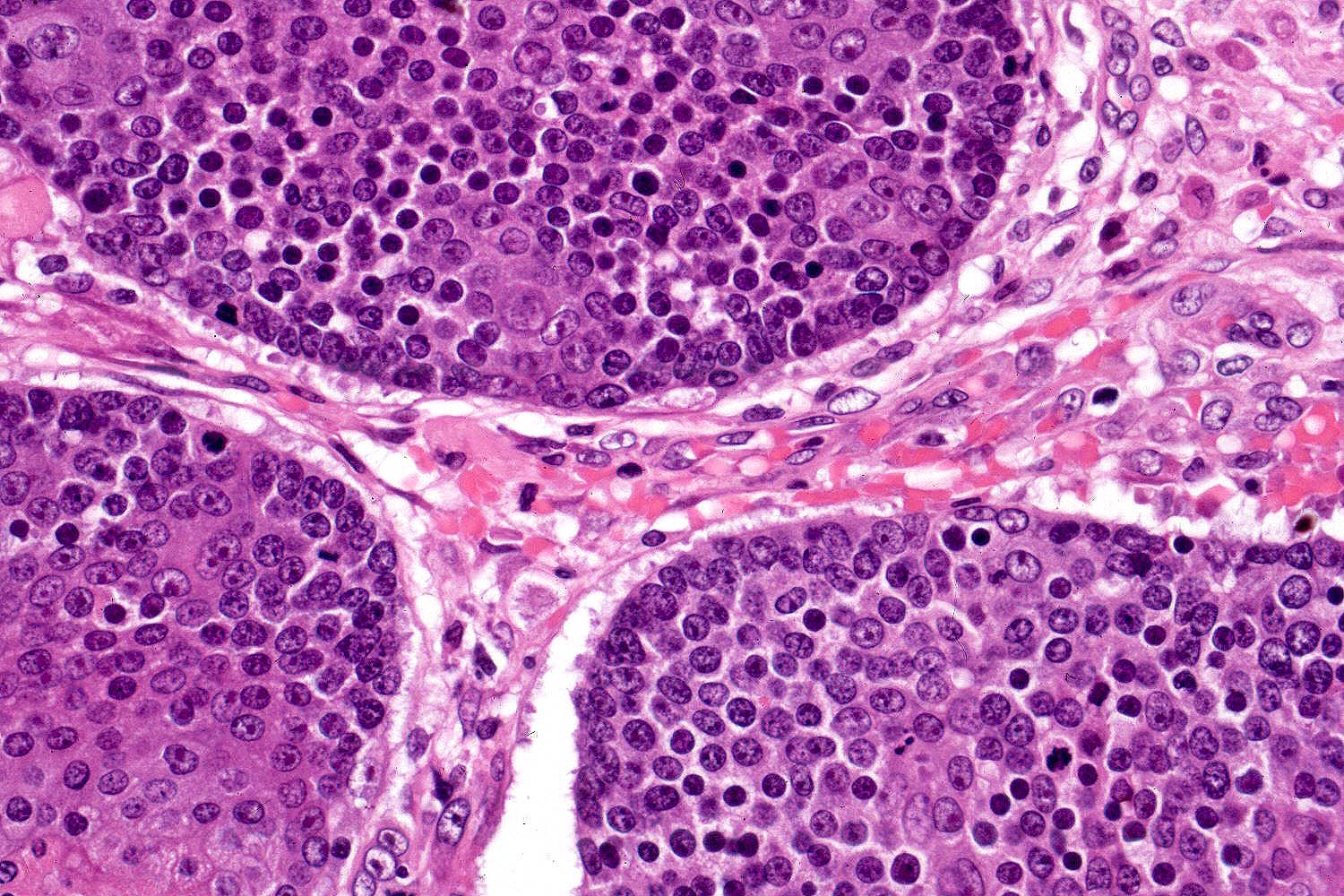 Pilomatricoma (pilomatrixoma, calcifying epithelioma of Malherbe ...