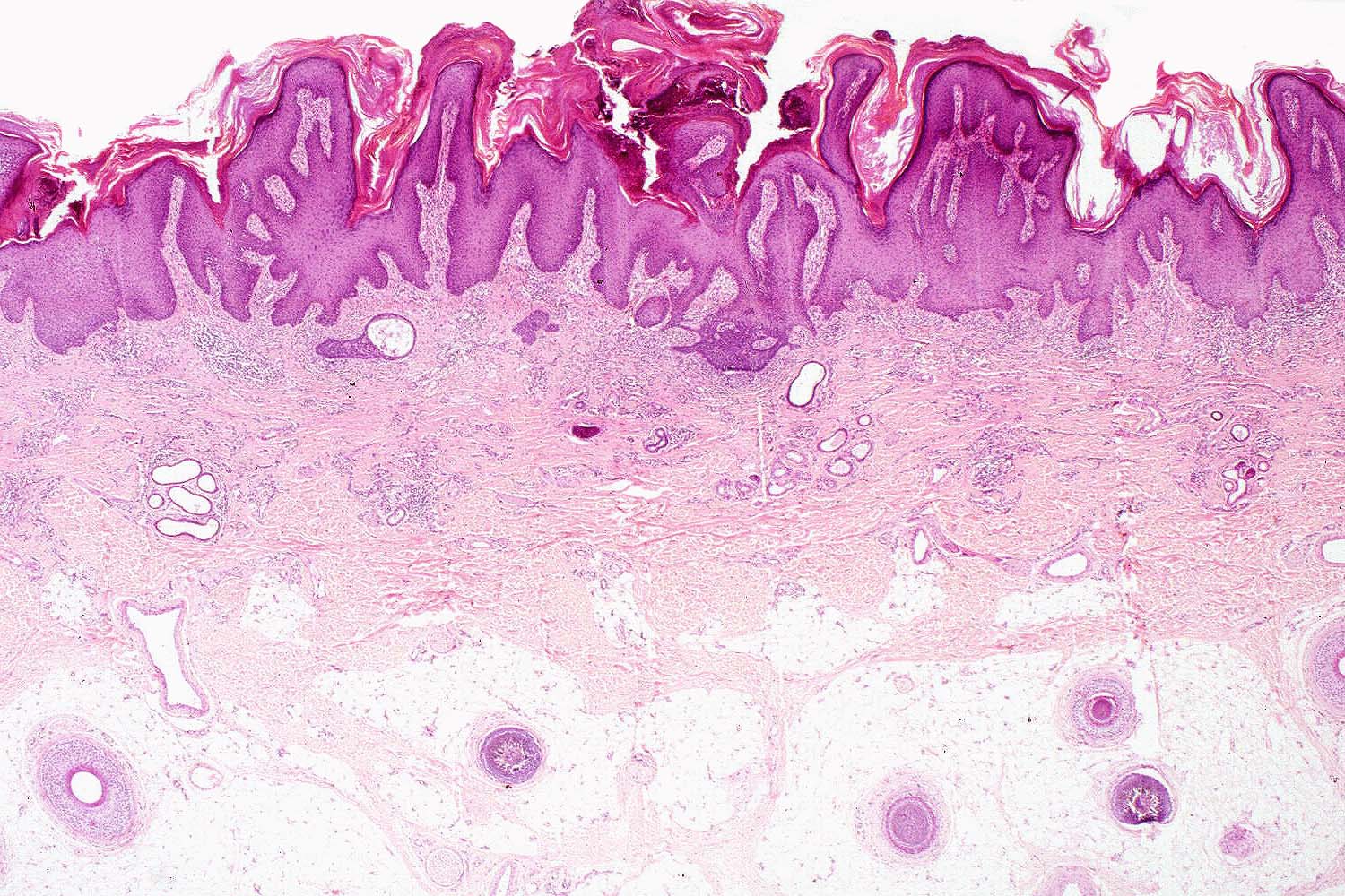 Nevus sebaceus (sebaceous nevus of Jadassohn, organoid nevus) – McKee Derm