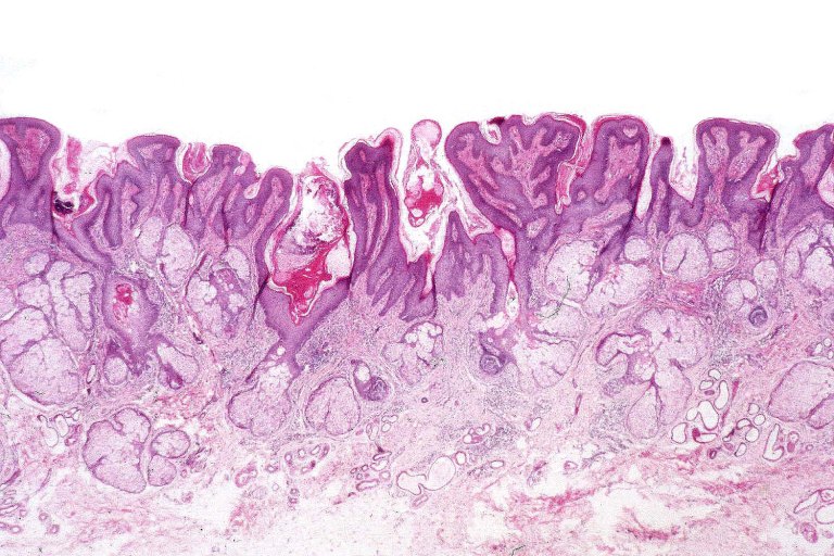 Nevus sebaceus (sebaceous nevus of Jadassohn, organoid nevus) – McKee Derm