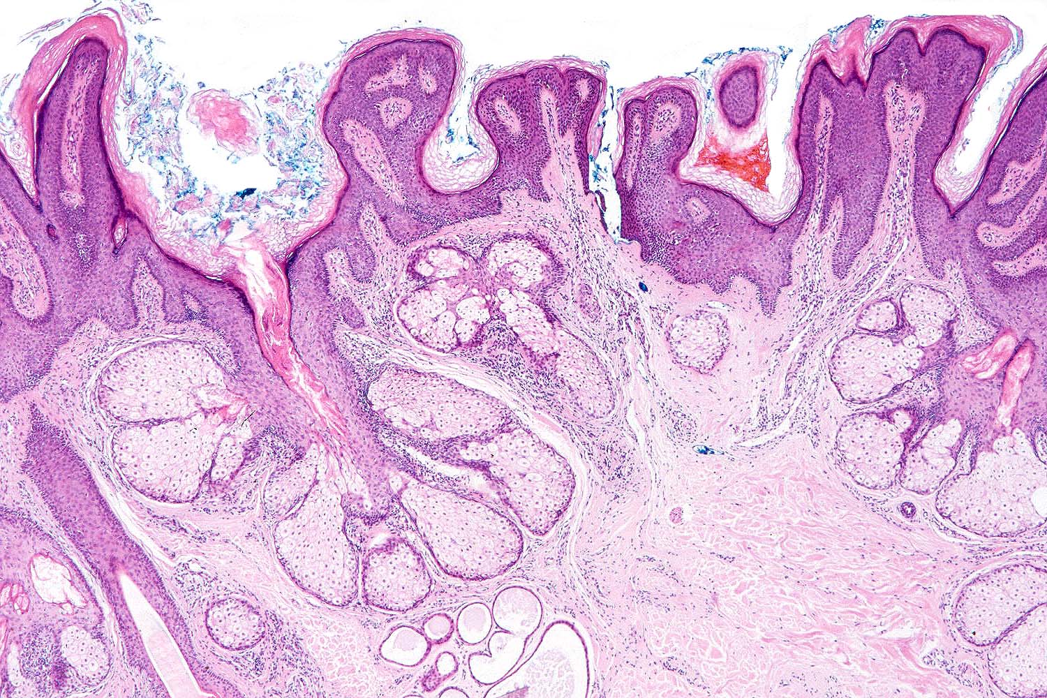 Nevus sebaceus (sebaceous nevus of Jadassohn, organoid nevus) – McKee Derm