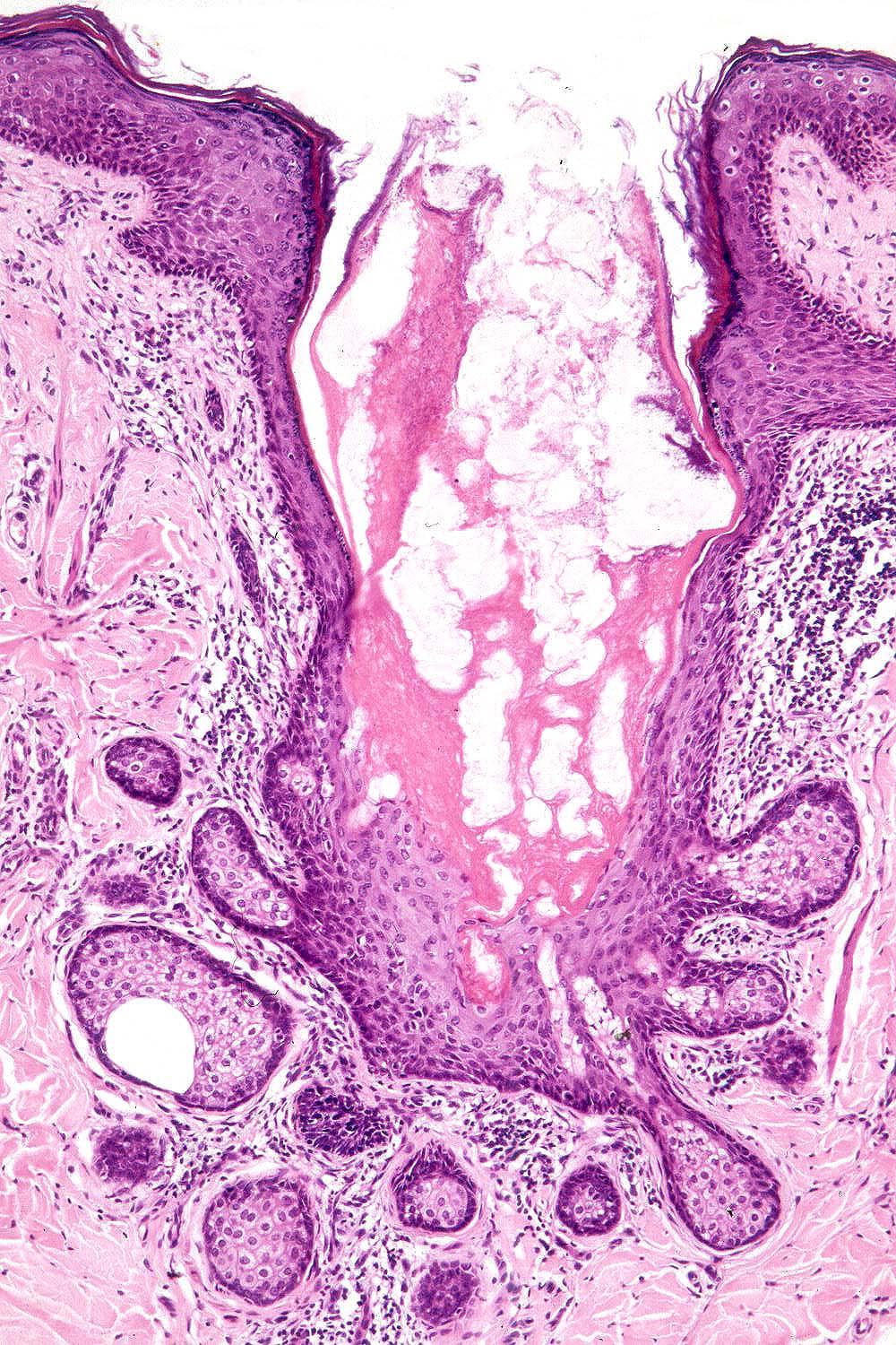 Nevus sebaceus (sebaceous nevus of Jadassohn, organoid nevus) – McKee Derm