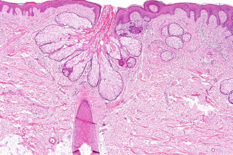 Nevus sebaceus (sebaceous nevus of Jadassohn, organoid nevus) – McKee Derm