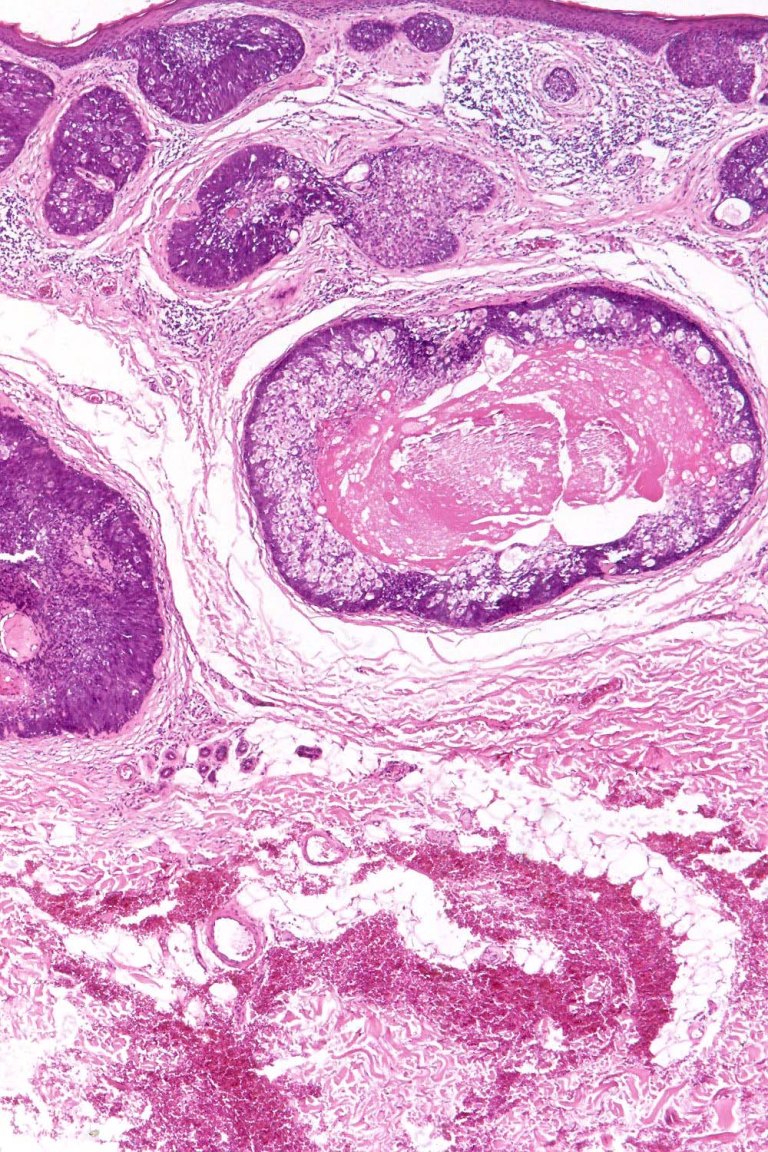 Sebaceous hyperplasia, sebaceous adenoma, sebaceoma & sebaceous ...