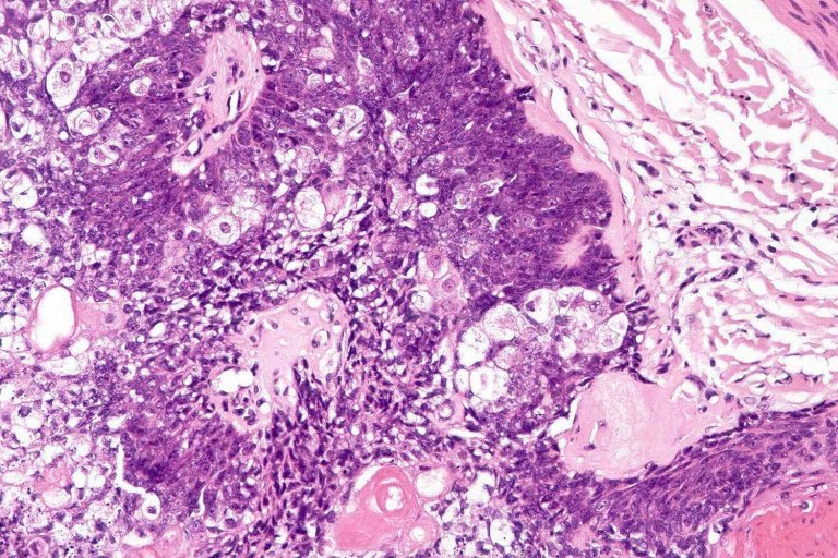Sebaceous hyperplasia, sebaceous adenoma, sebaceoma & sebaceous ...