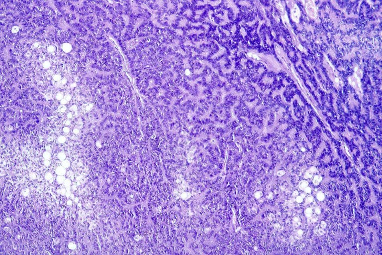 Sebaceous hyperplasia, sebaceous adenoma, sebaceoma & sebaceous ...