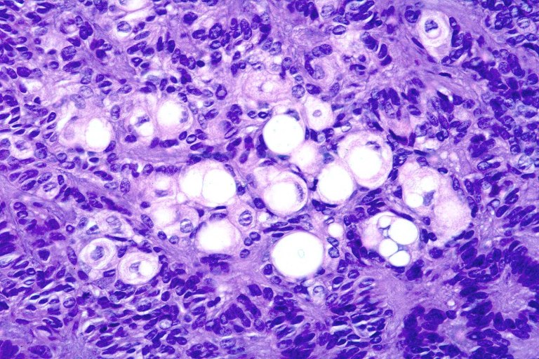 Sebaceous hyperplasia, sebaceous adenoma, sebaceoma & sebaceous ...