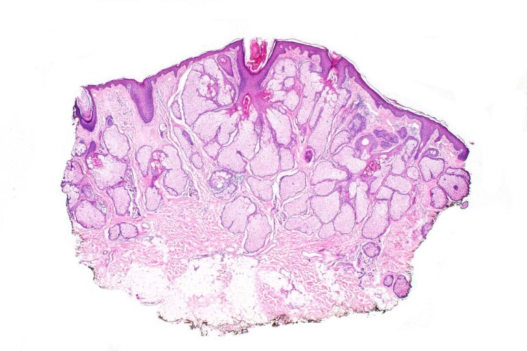 Sebaceous hyperplasia, sebaceous adenoma, sebaceoma & sebaceous ...