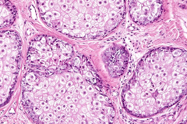 Sebaceous hyperplasia, sebaceous adenoma, sebaceoma & sebaceous ...