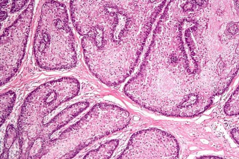 Sebaceous hyperplasia, sebaceous adenoma, sebaceoma & sebaceous ...