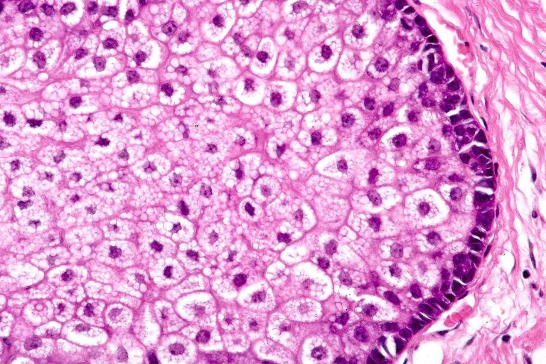 Sebaceous hyperplasia, sebaceous adenoma, sebaceoma & sebaceous ...