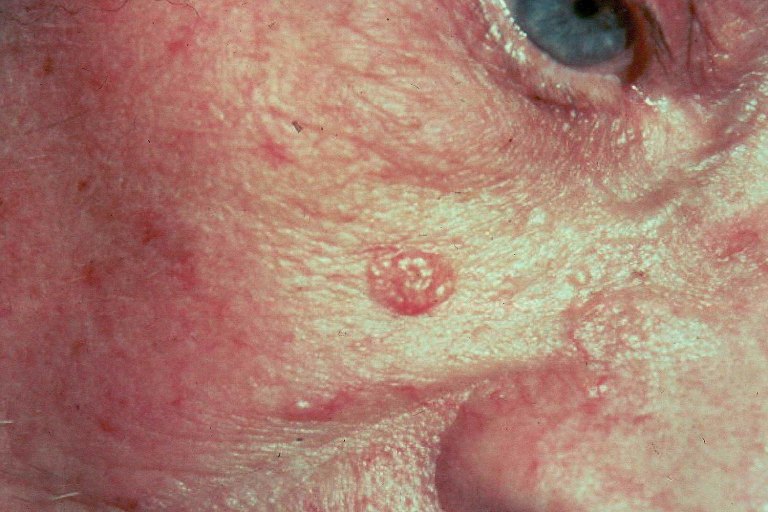 Sebaceous hyperplasia, sebaceous adenoma, sebaceoma & sebaceous ...