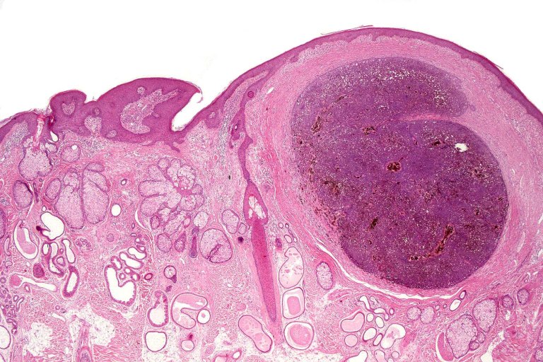 Nevus sebaceus (sebaceous nevus of Jadassohn, organoid nevus) – McKee Derm