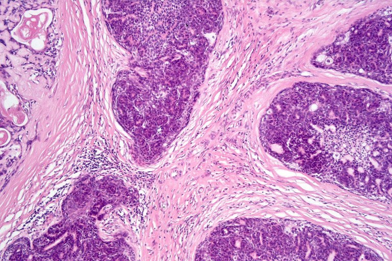 Sebaceous hyperplasia, sebaceous adenoma, sebaceoma & sebaceous ...