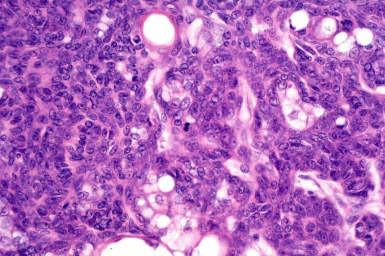 Sebaceous hyperplasia, sebaceous adenoma, sebaceoma & sebaceous ...