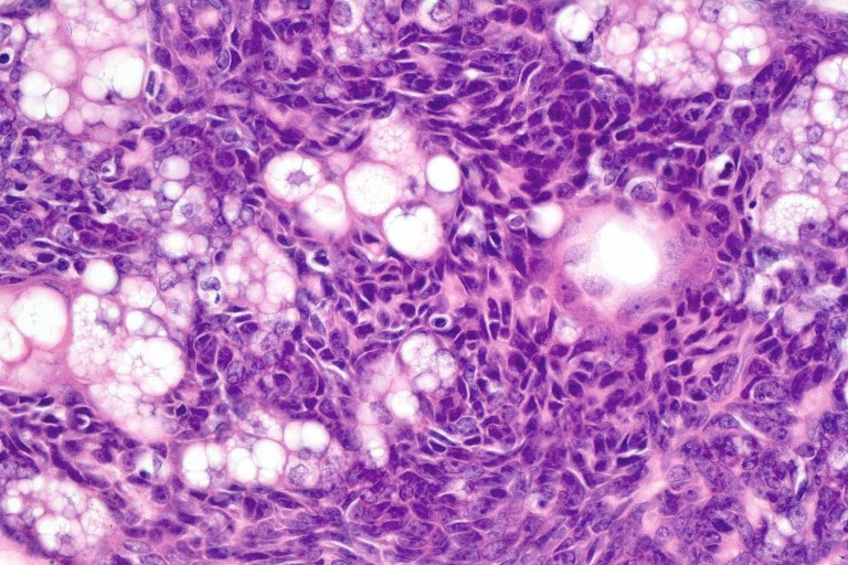 Sebaceous hyperplasia, sebaceous adenoma, sebaceoma & sebaceous ...