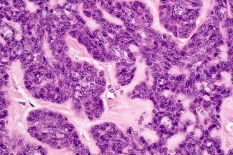 Sebaceous hyperplasia, sebaceous adenoma, sebaceoma & sebaceous ...