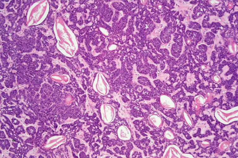 Sebaceous hyperplasia, sebaceous adenoma, sebaceoma & sebaceous ...