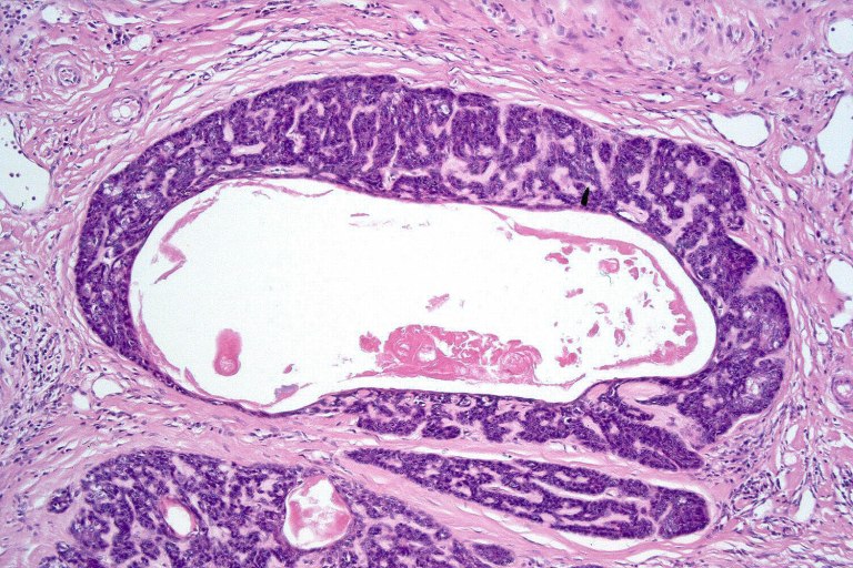 Sebaceous hyperplasia, sebaceous adenoma, sebaceoma & sebaceous ...