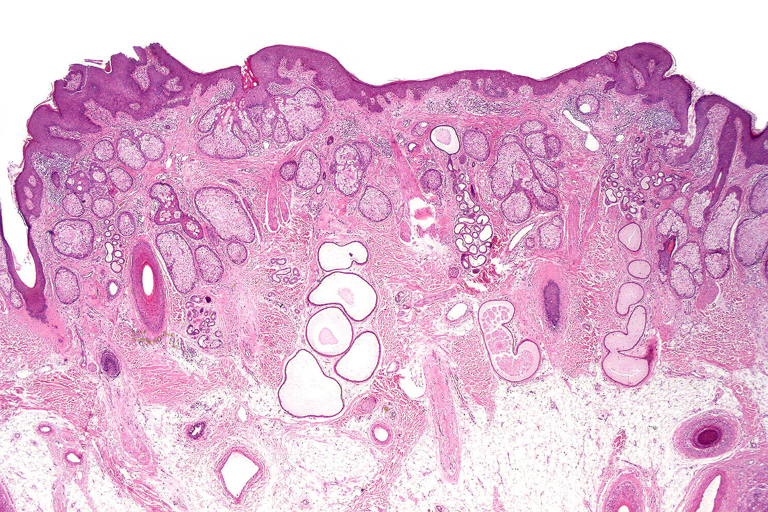 Nevus sebaceus (sebaceous nevus of Jadassohn, organoid nevus) – McKee Derm