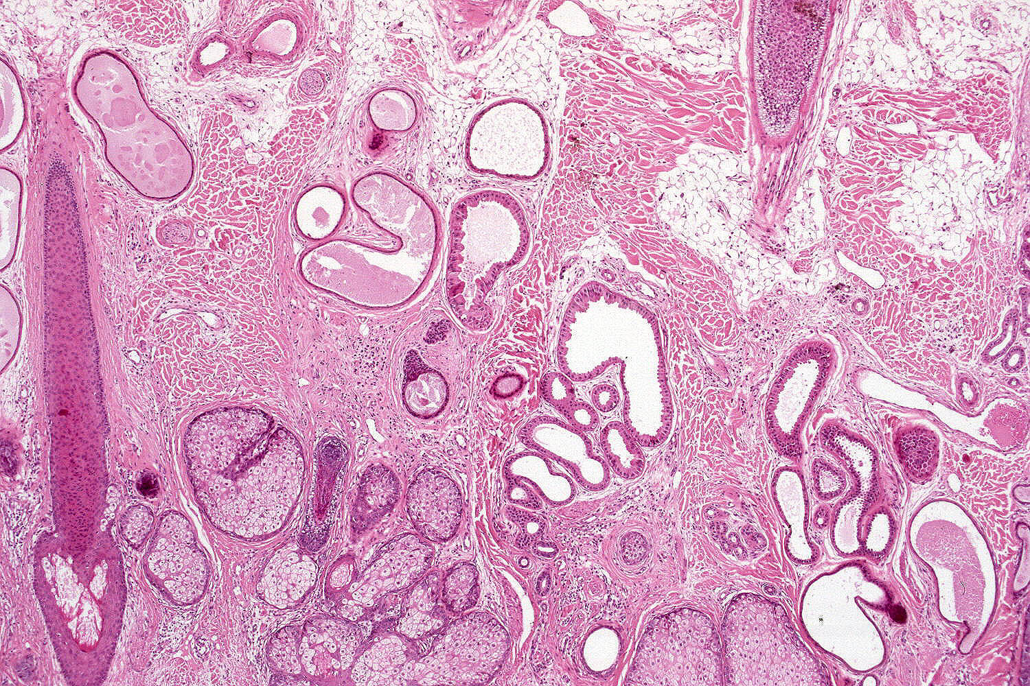 Nevus sebaceus (sebaceous nevus of Jadassohn, organoid nevus) – McKee Derm
