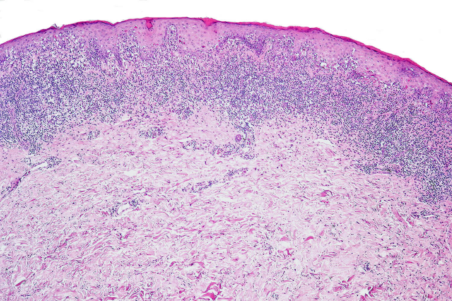 Lichenoid keratosis for the residents & fellows – McKee Derm