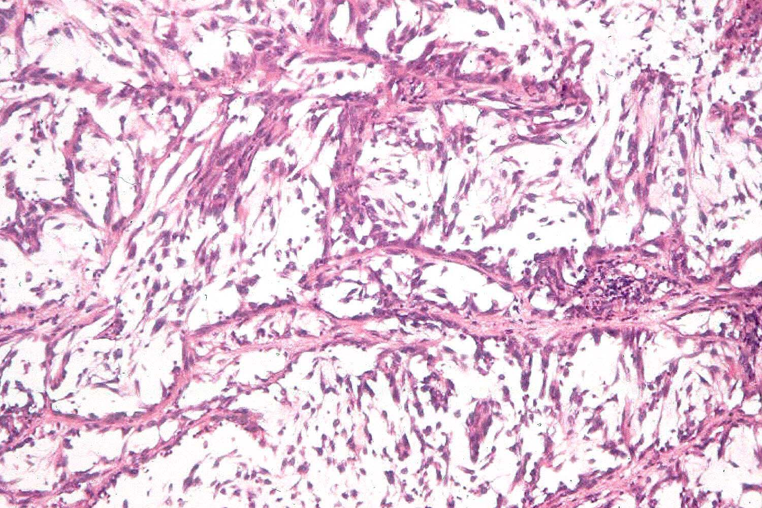 Squamous cell carcinoma in patients with dystrophic epidermolysis ...