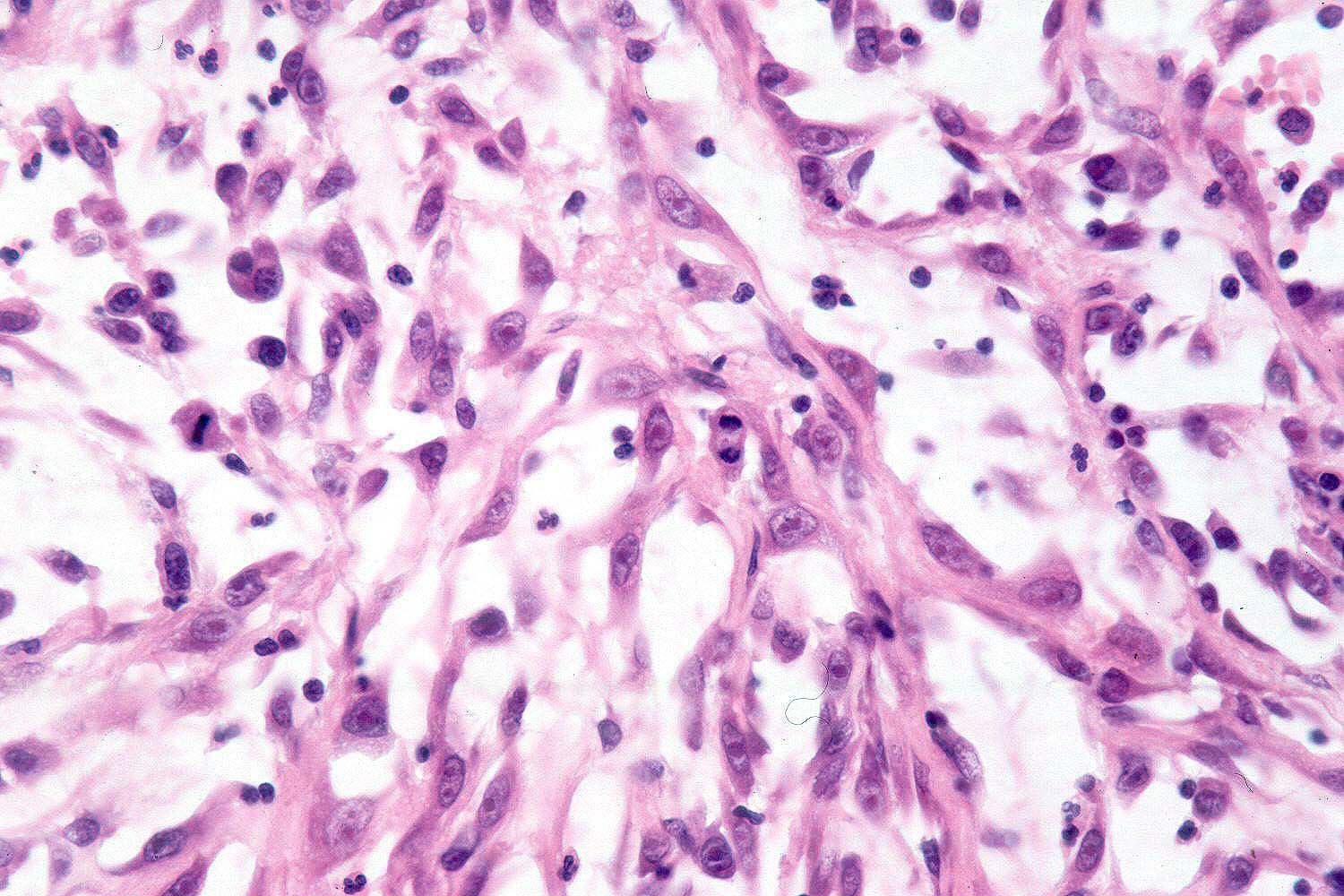 Squamous cell carcinoma in patients with dystrophic epidermolysis ...