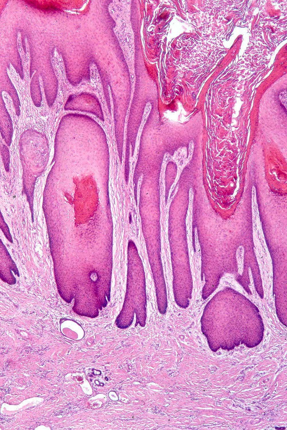 Squamous cell carcinoma in patients with dystrophic epidermolysis ...