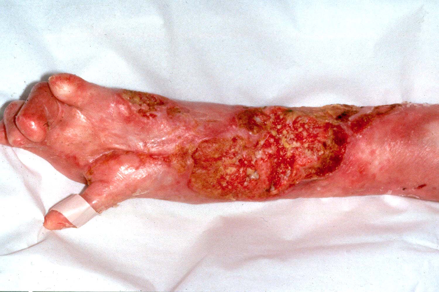 Squamous cell carcinoma in patients with dystrophic epidermolysis ...