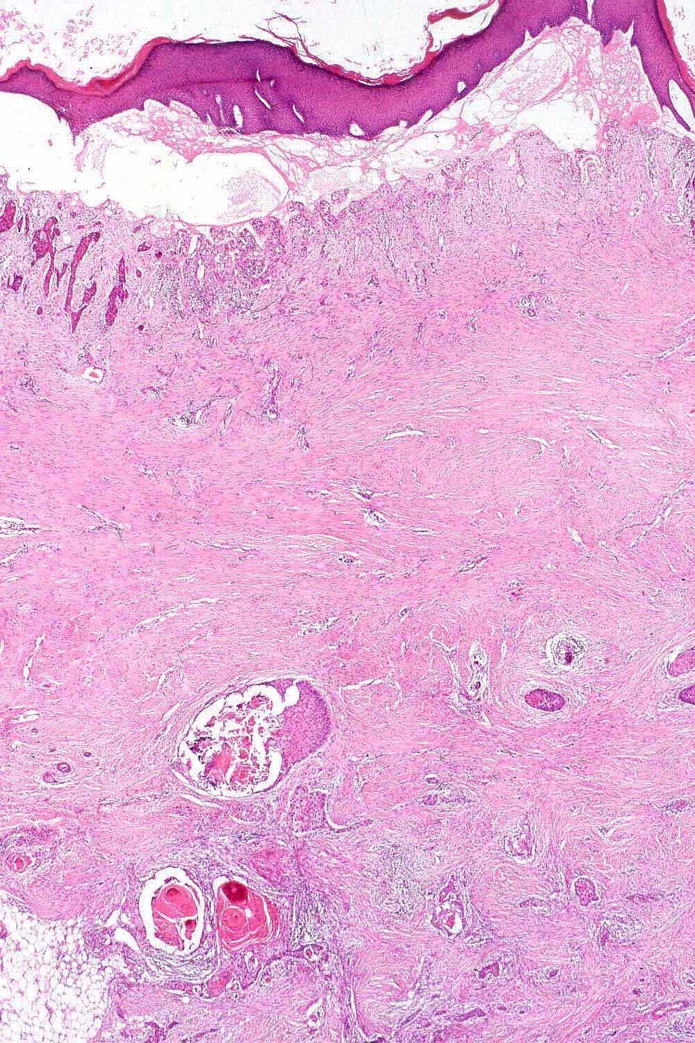 Squamous cell carcinoma in patients with dystrophic epidermolysis ...