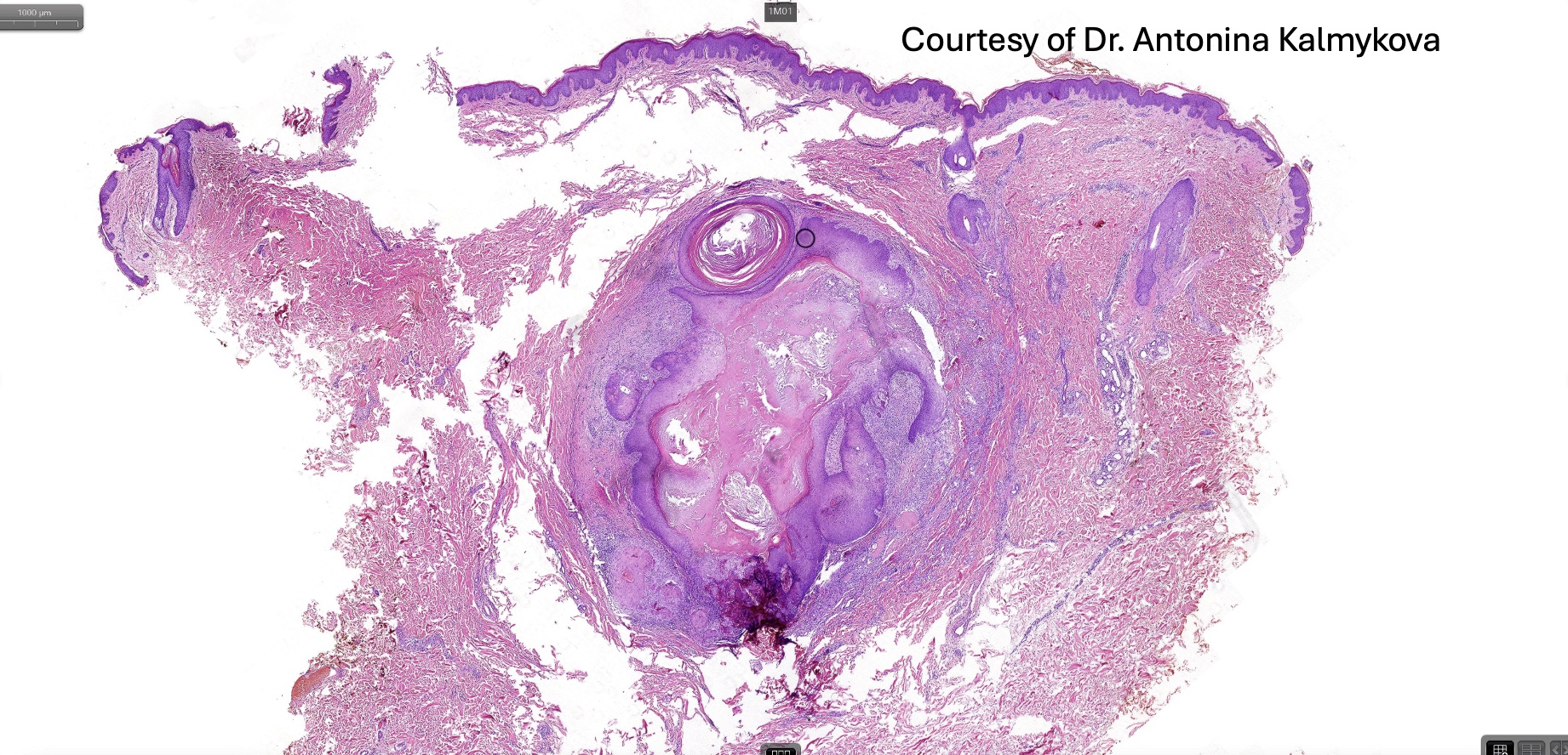 Verrucous cyst – McKee Derm