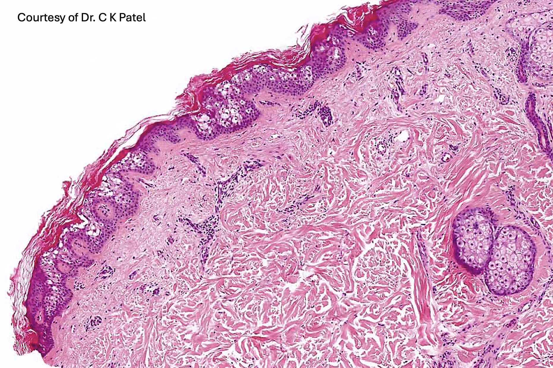 Epidermolytic acanthoma – McKee Derm
