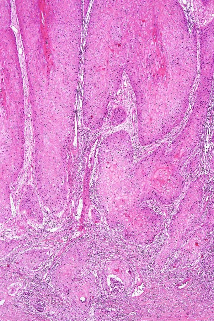 Cutaneous verrucuous carcinoma – McKee Derm