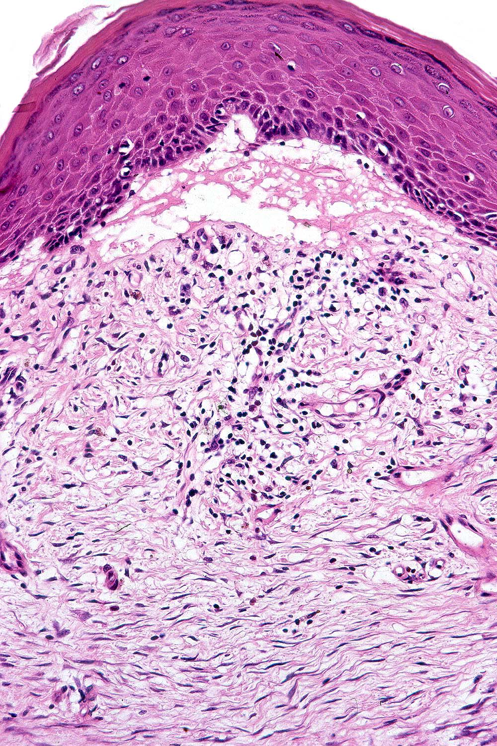 Squamous cell carcinoma in patients with dystrophic epidermolysis ...