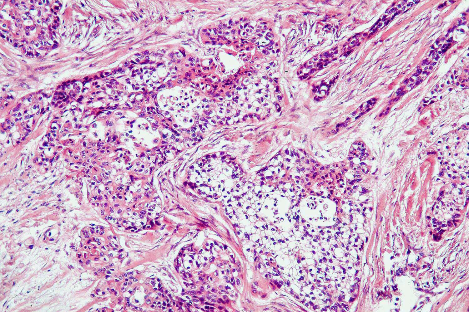 Clear cell squamous carcinoma for the residents – McKee Derm