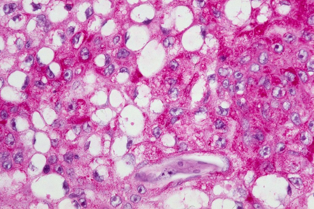 Clear cell squamous carcinoma for the residents – McKee Derm