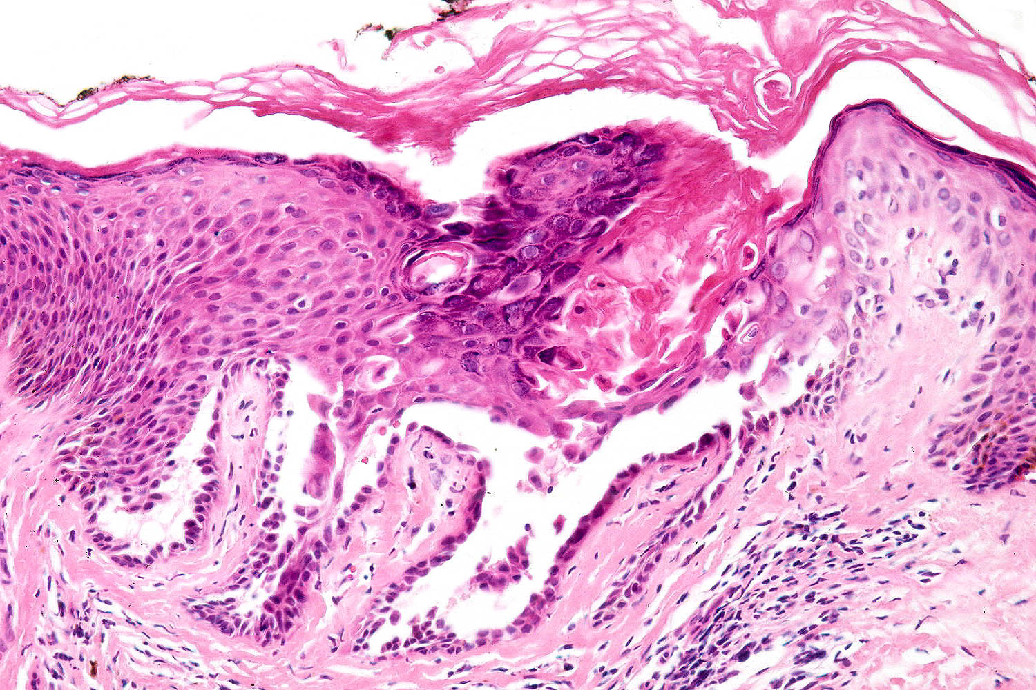 Acantholytic acanthoma, acantholytic dermatosis of the genitocrural ...